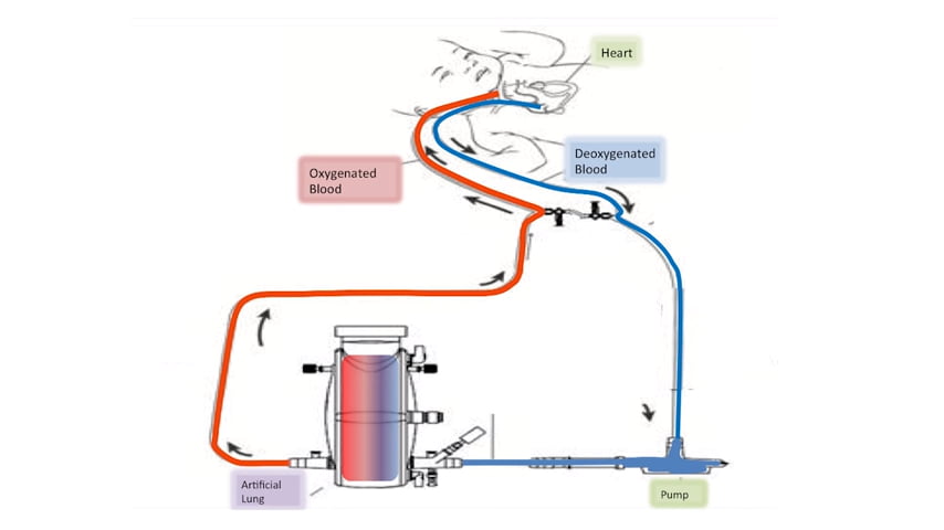 All you need to know about Extracorporeal membrane oxygenation (ECMO ...