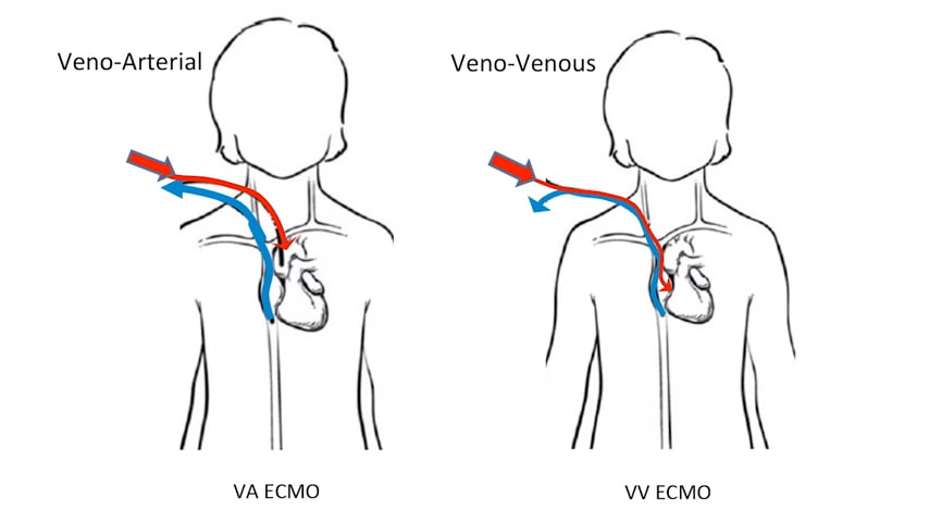 All you need to know about Extracorporeal membrane oxygenation (ECMO ...